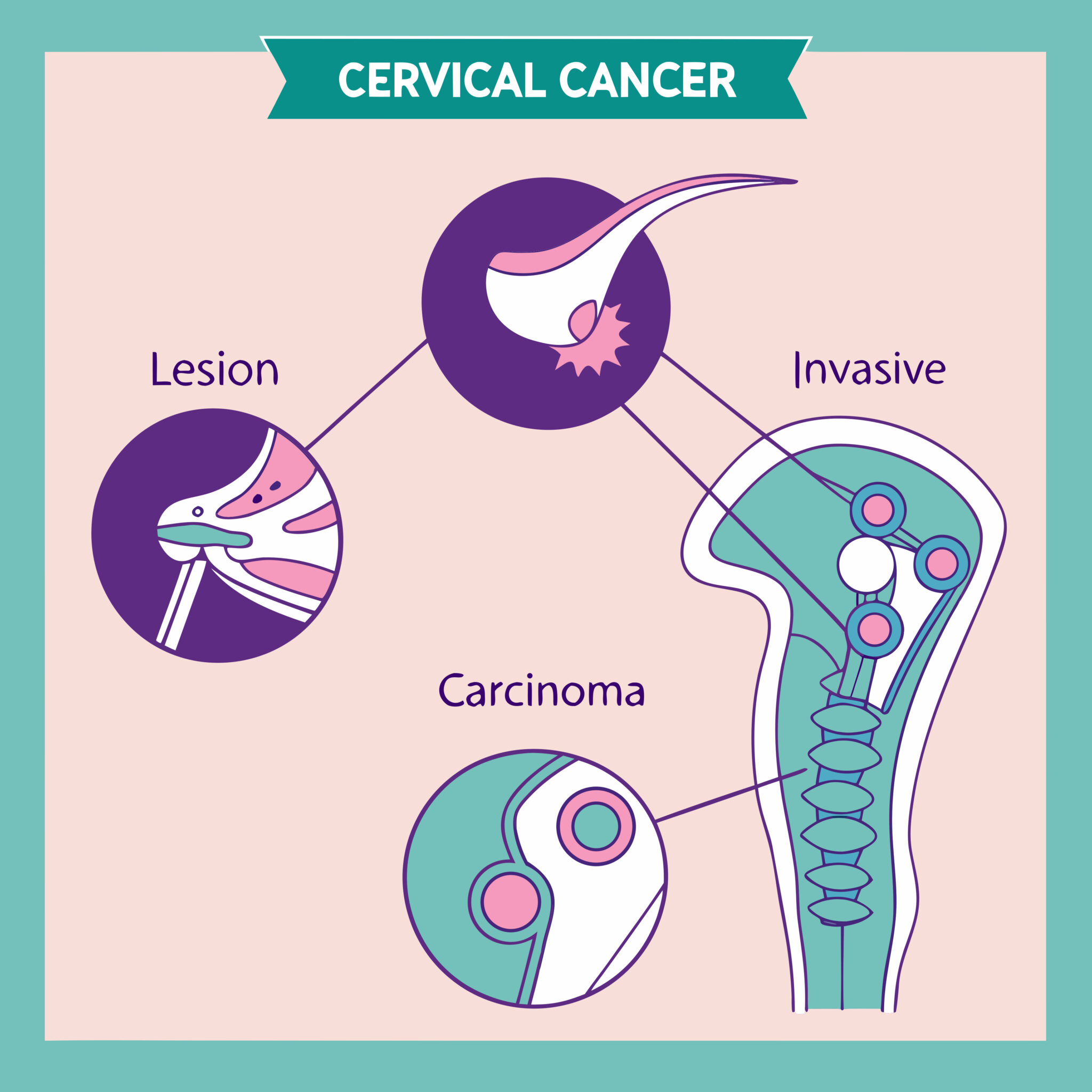 Cervical Cancer Prevention - Kintegra Health